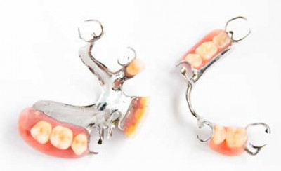 PROTHÈSE DENTAIRE STELLITE | Cabinet Dentaire | Levallois-Perret 92